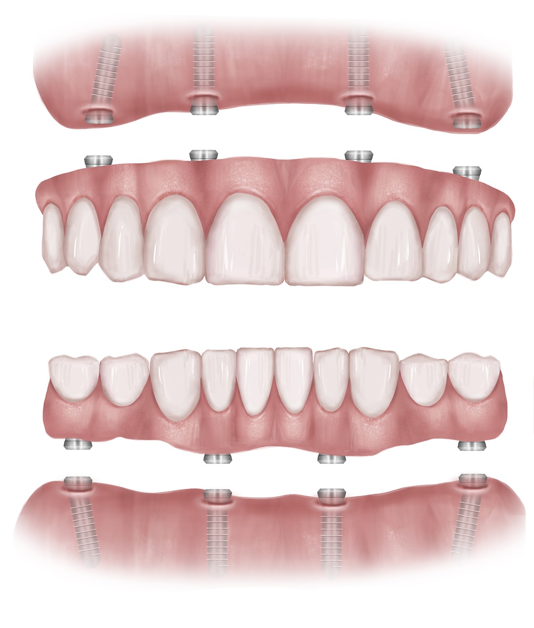 All-on-4 Implants - The Dental Implant Guide