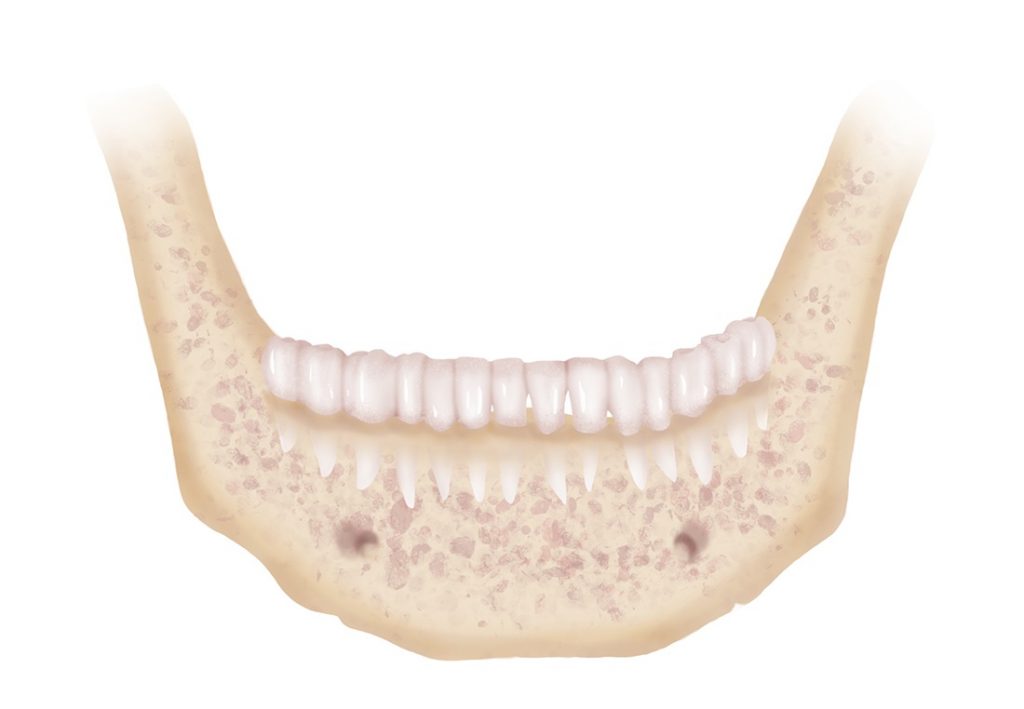 Bone Resorption - The Dental Implant Guide
