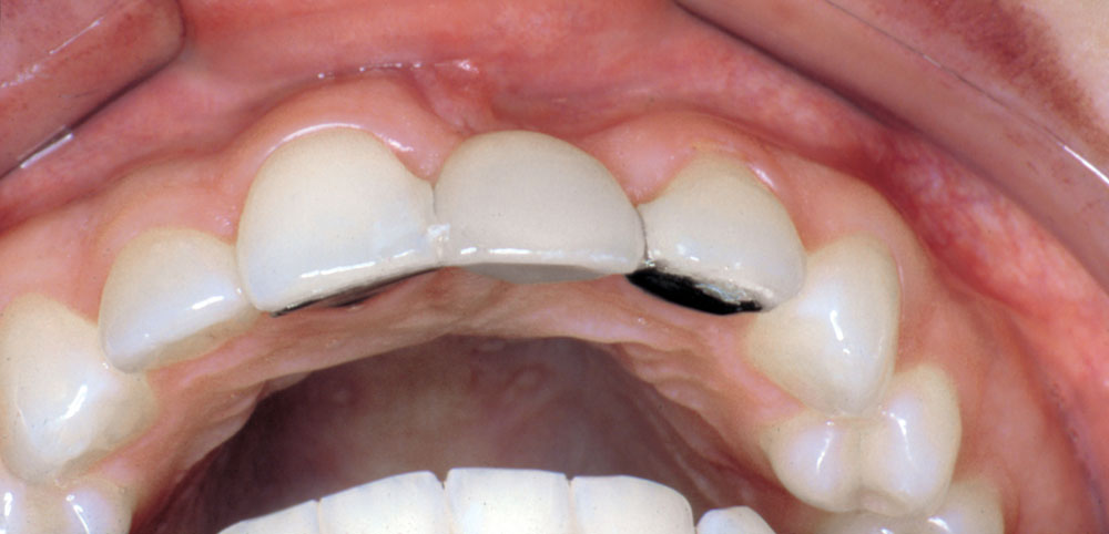 Single Anterior Tooth - The Dental Implant Guide