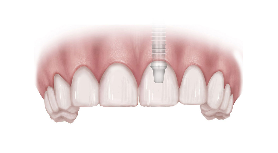 Replacement Teeth - The Dental Implant Guide