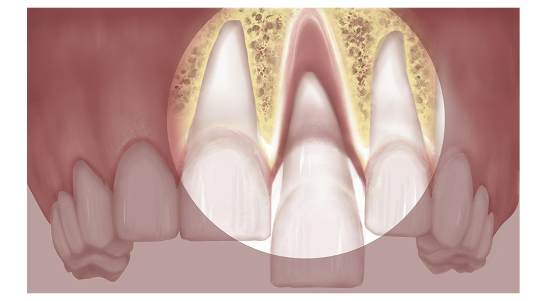 Surgical Extractions - The Dental Implant Guide