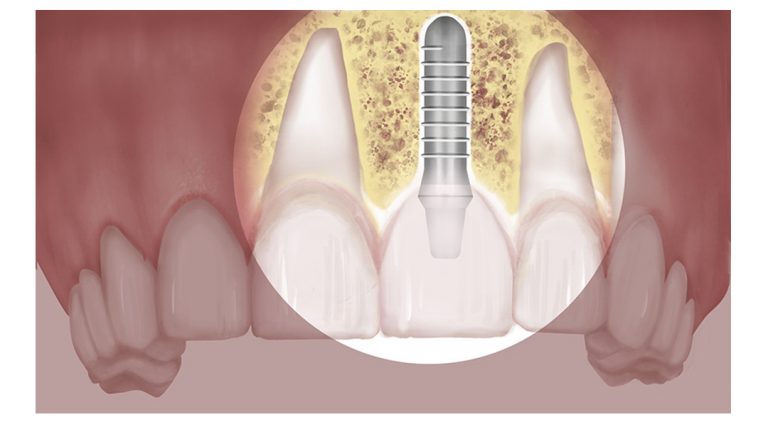 Bone Grafting & Sinus Lift - The Dental Implant Guide