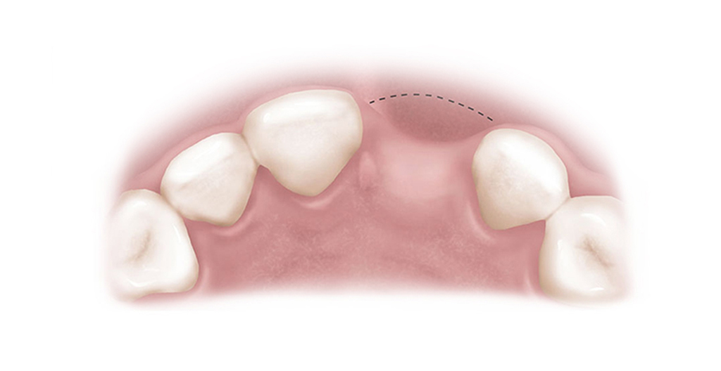 Bone Resorption - The Dental Implant Guide